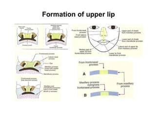 cleft lip and palate | PPTX