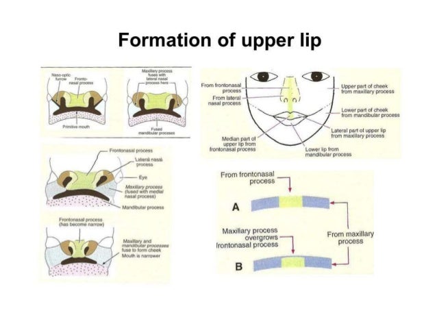 cleft lip and palate