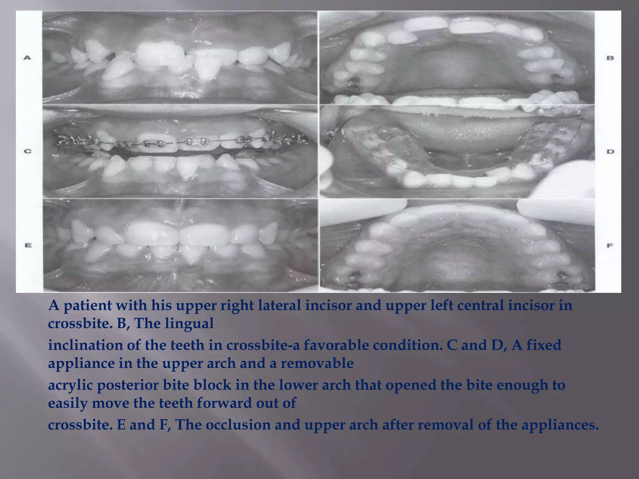 Cl 1 malocclusion | PPTX