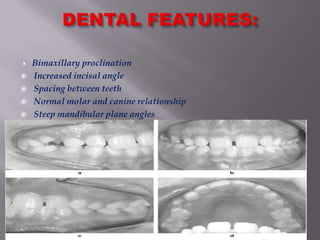 Cl 1 malocclusion | PPTX