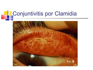 Clamidia Trachomatis | PPT