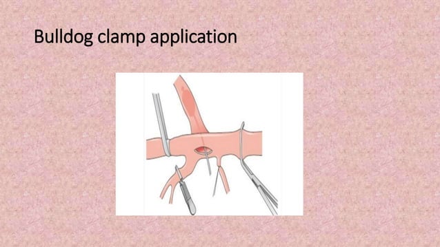 Clamping and occluding instrument | PPTX | First Aid | Injuries
