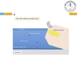 Contact Lens and Dry Eyes : How to choose lens PPT.pptx