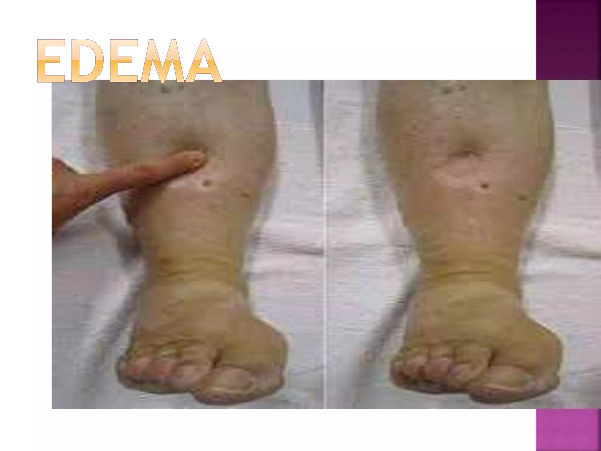 Causas y tipos de edema | PPT