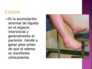 Fisiopatologia Edema | PPTX
