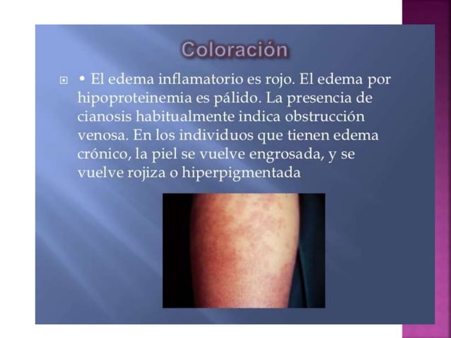 Fisiopatologia Edema | PPTX