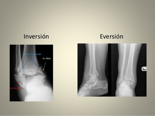 Clase 15.-fracturas-del-tobillo-y-pie