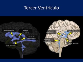 Adhesión Intertalámica