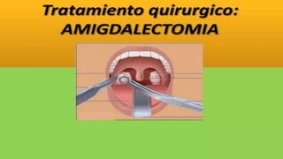 CLASE-AMIGDALECTOMÍA-QUIRURGICO III.pptx