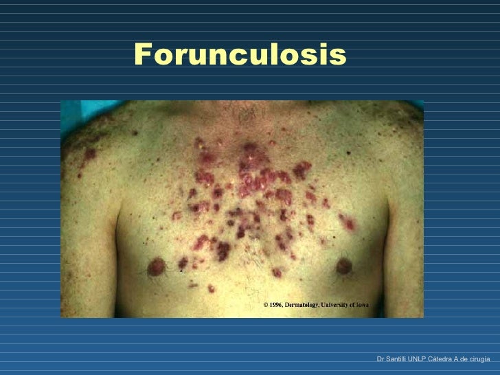 Clase De Infeccion Y Cirugia