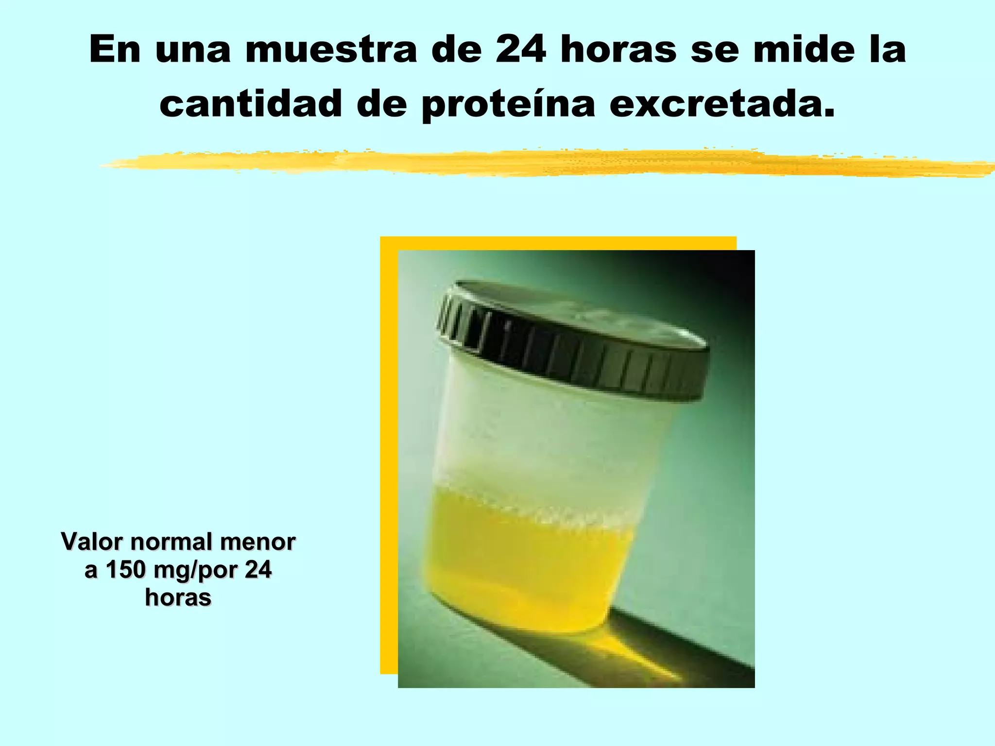 Proteinuria y sus causas