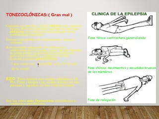 Clase epilepsia | PPT