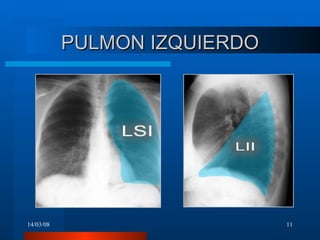 Radiología del Pulmón: anatomía lobar y segmentaria | PPT