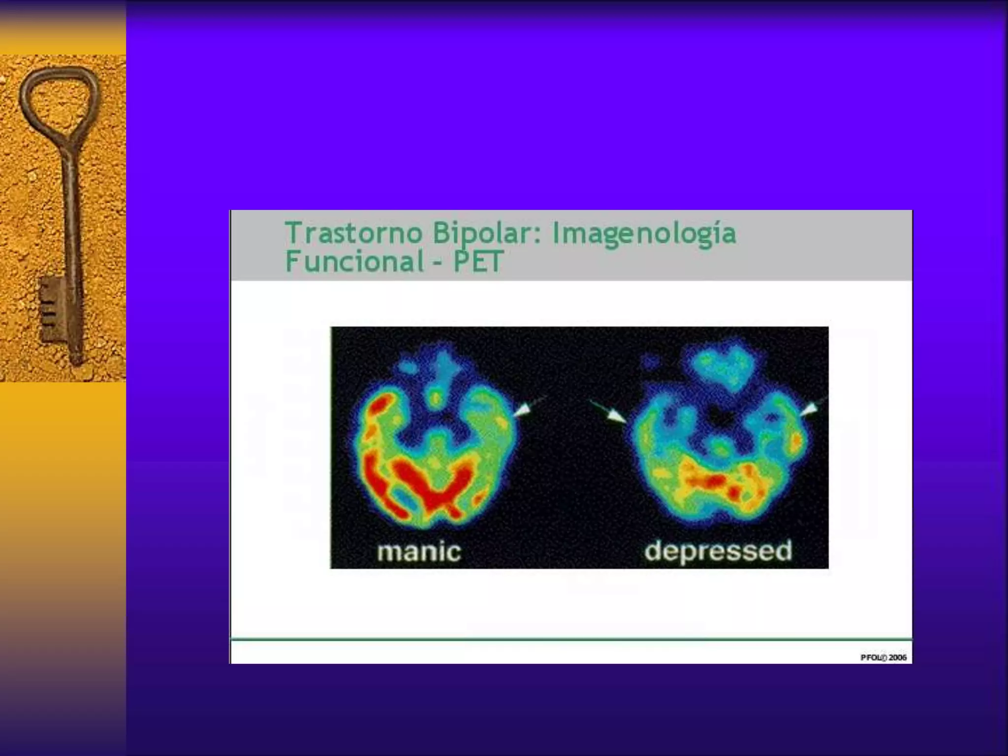 TAB -Transtorno Afectivo Bipolar- | PPTX | Brain and Nervous System ...