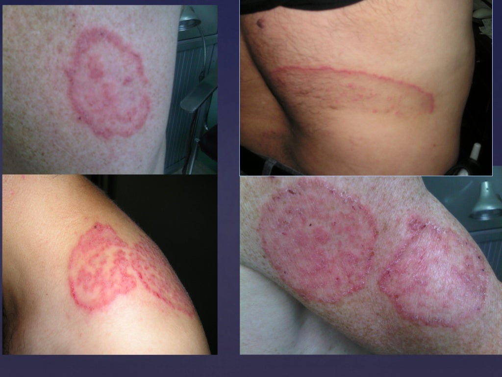 Clase 12 dermatofitosis 2015