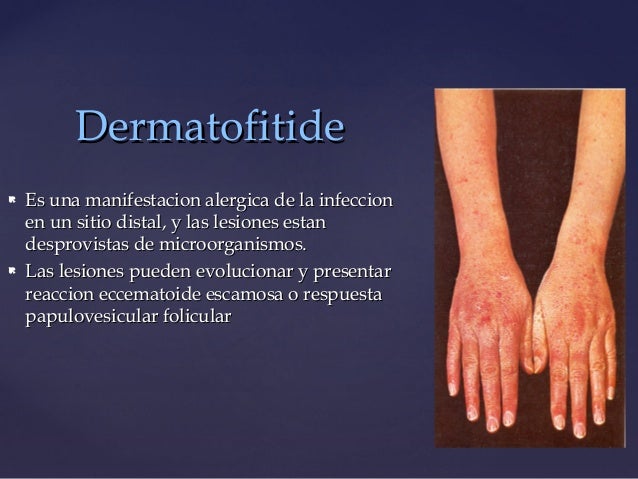 Clase 12 dermatofitosis 2015