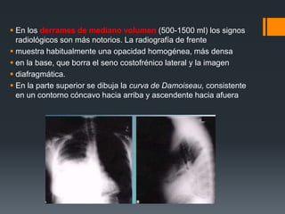 DERRAME PLEURAL | PPTX