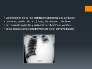 derrame pleural | PPTX