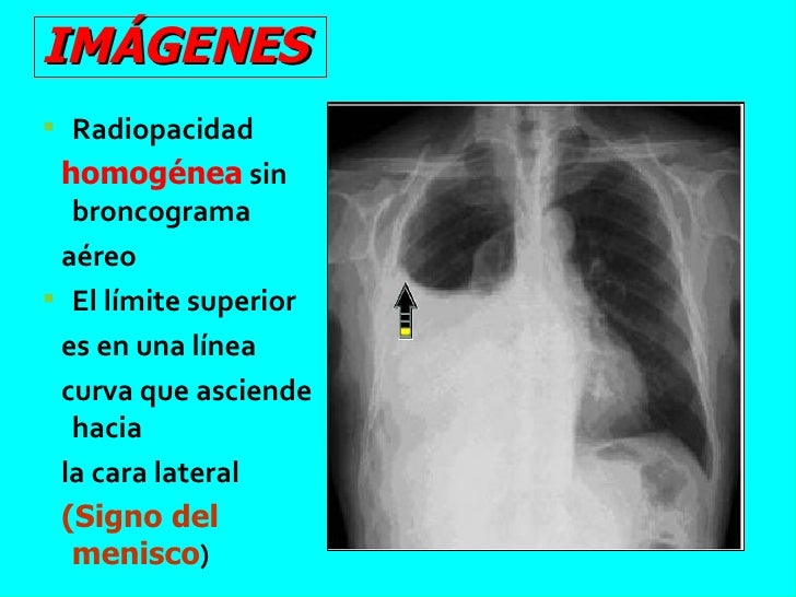 Clase 13 enfermedad pleural