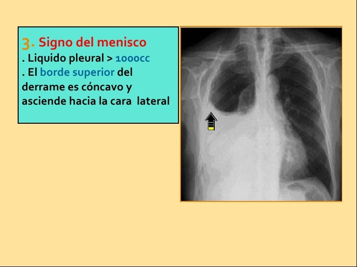 Clase 13 enfermedad pleural