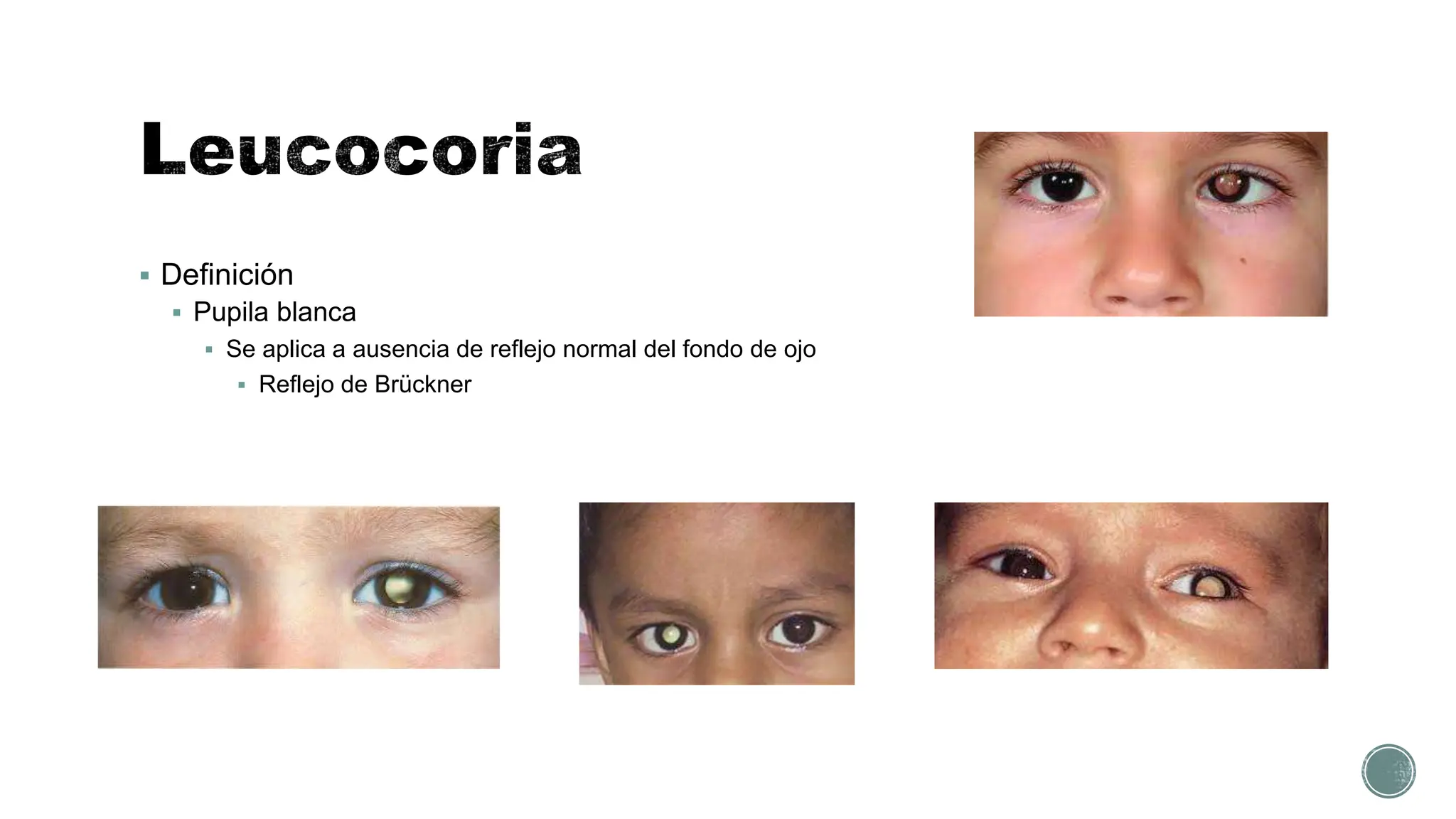 Clase 19 Leucocoria para la materia de oftalmología | PPTX