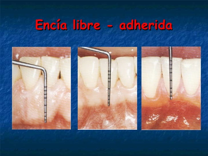 Encia Libre Y Encia Adherida - Citas Adultos En Zaragoza