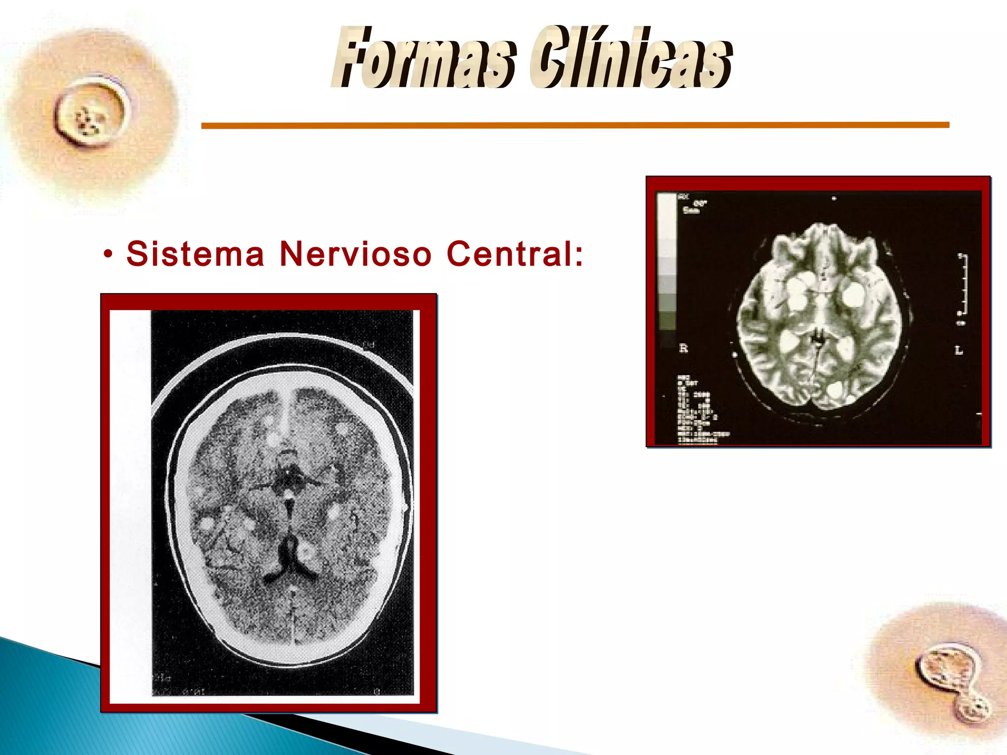 Clase 20 cryptococosis, candidiasis, trichosporonosis y malasseziosis ...