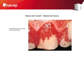 Clase 4 periodontograma e indices | PPTX