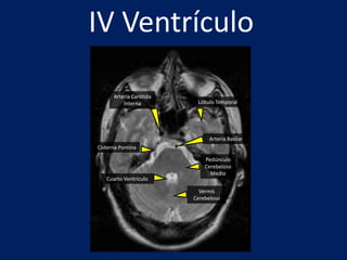 Clase5 vascularizacionmeningesyventriculos-151026002005-lva1-app6892 | PDF