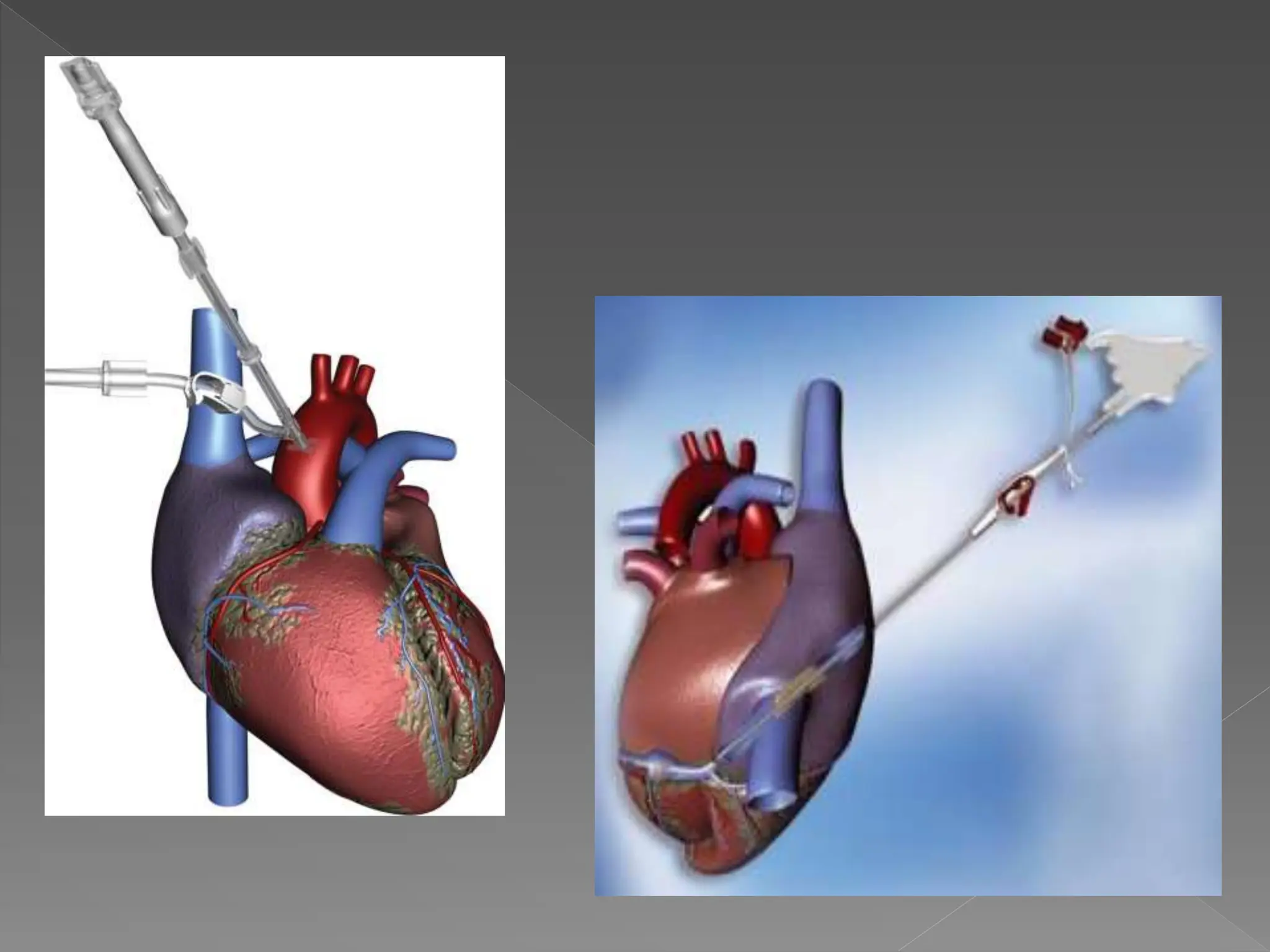 Clase 5 CCV UNAJ Reemplazo Valvula Aortica Y Mitral | PPT