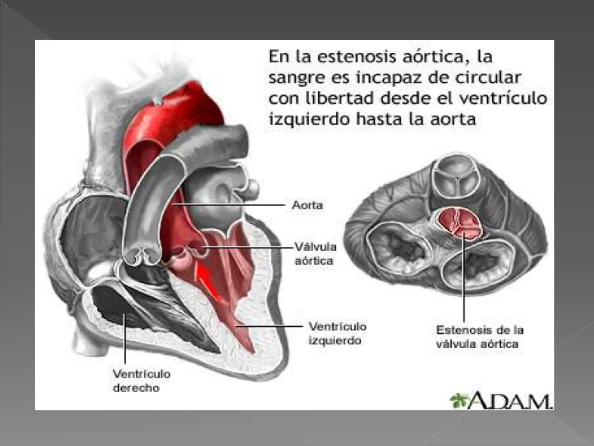 Clase 5 CCV UNAJ Reemplazo Valvula Aortica Y Mitral | PPT