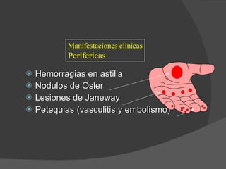Clase 5 Endocarditis Infecciosa | PPT