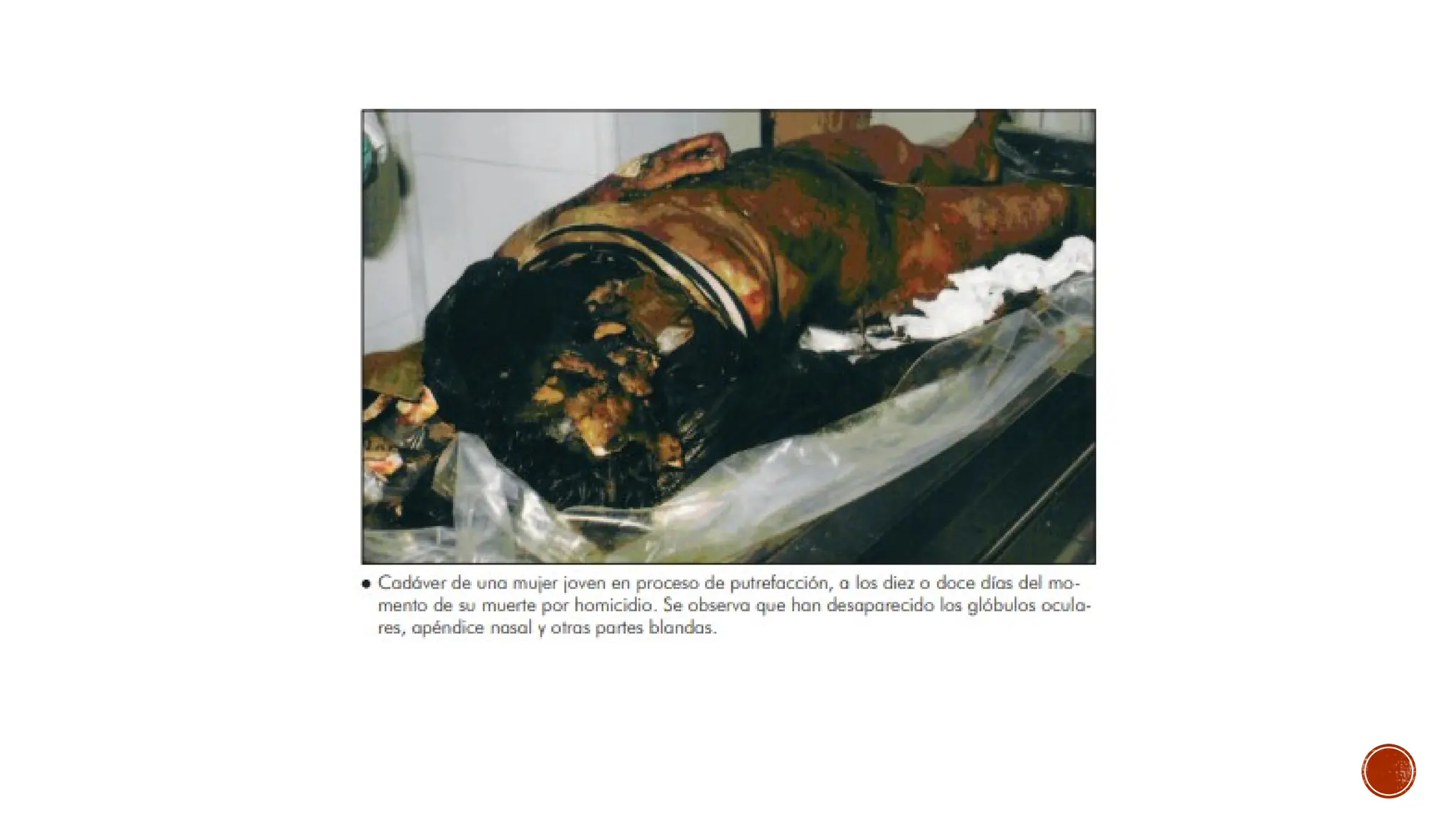 Hallazgos de los principales fenomenos cadavericos.pptx