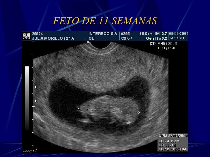 Ecografia feto 11 semanas - Imagui