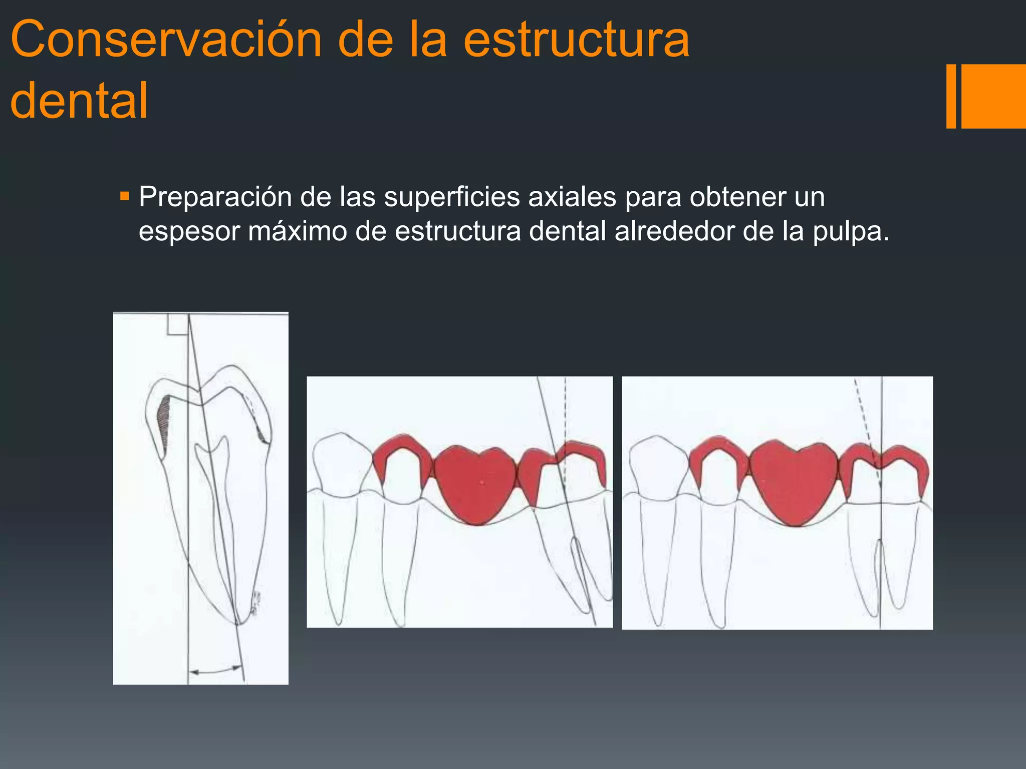 Principios para el tallado de dientes en prótesis | PPTX | Oral care ...