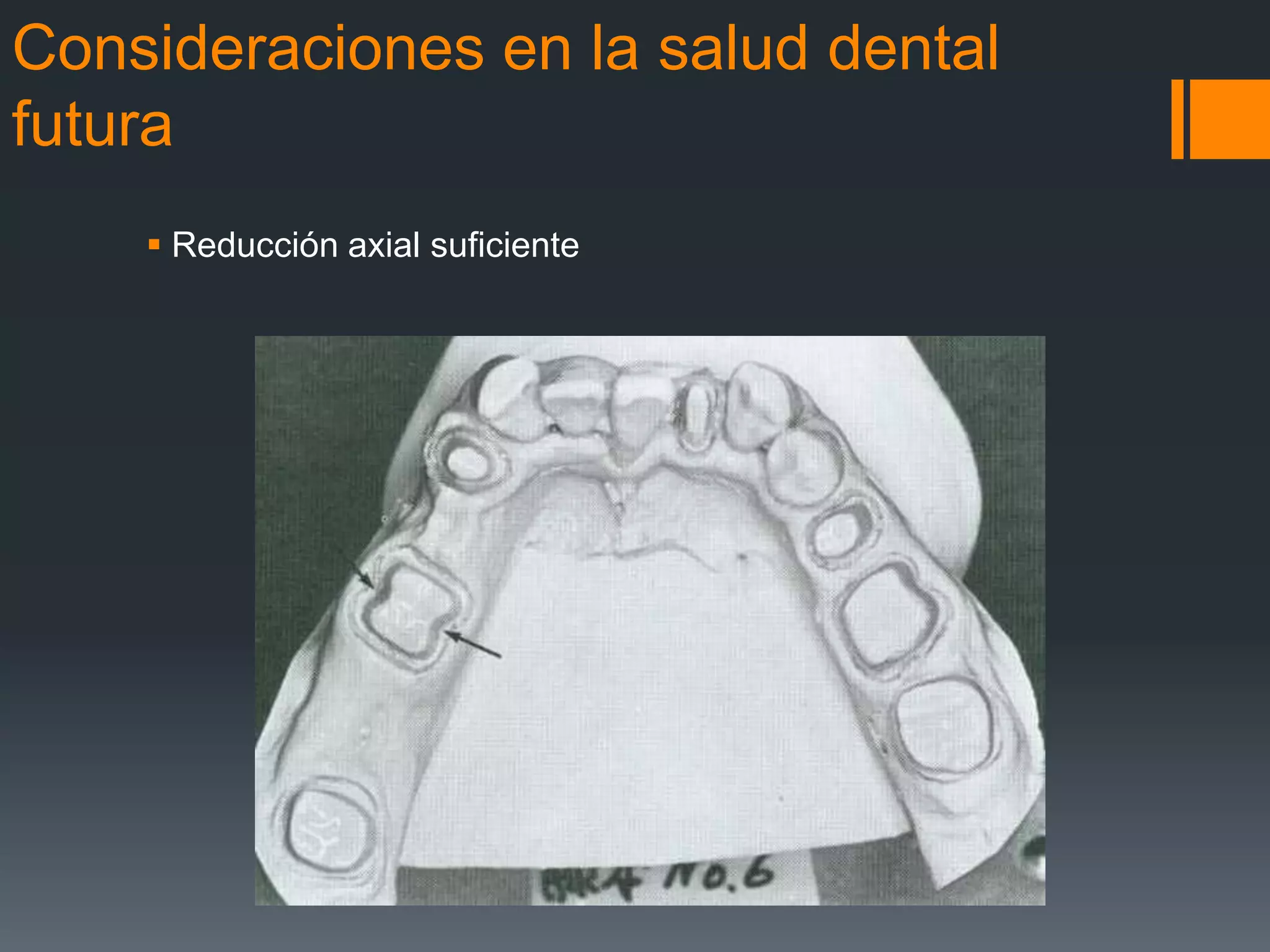 Principios para el tallado de dientes en prótesis | PPTX | Oral care ...