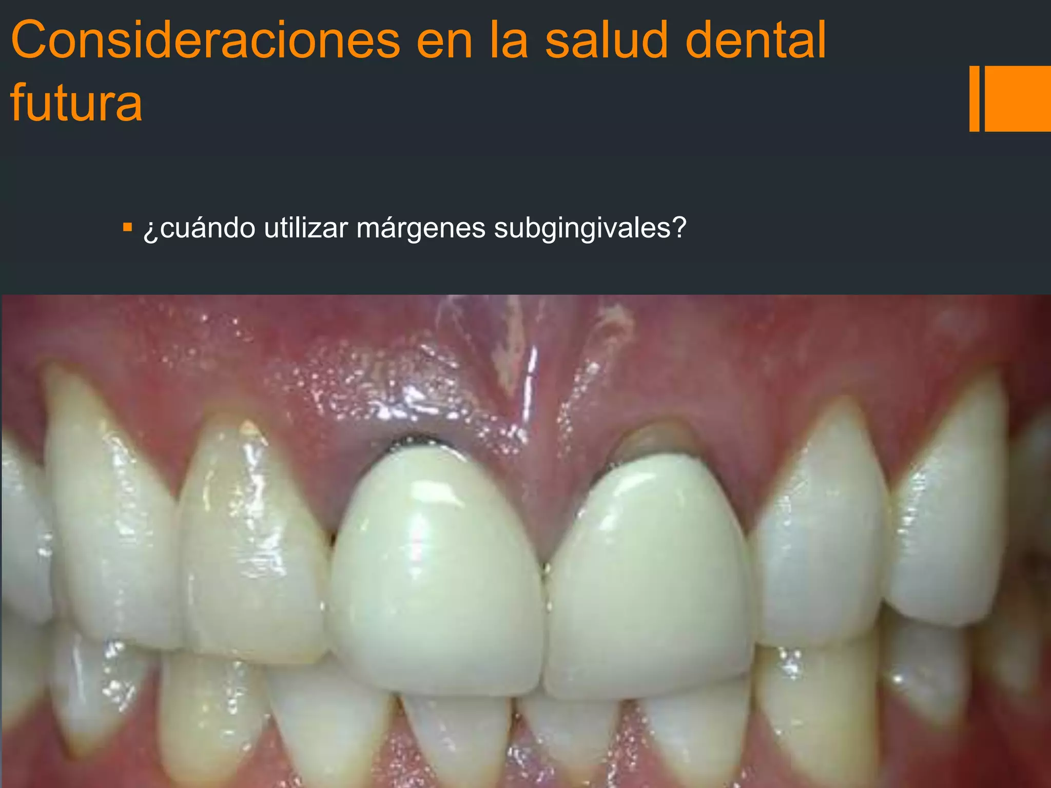 Principios para el tallado de dientes en prótesis | PPTX | Oral care ...