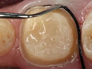 Principios para el tallado de dientes en prótesis | PPTX