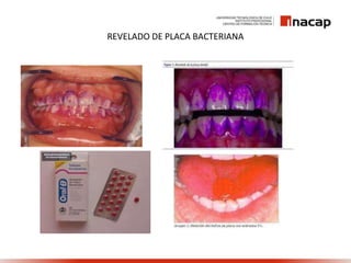 Clase 5 tratamiento periodontal higienene bucal | PPTX