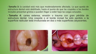 Clasificación de las Lesiones Cariosas | PPTX