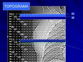 CLASE 6 TC de TORAX.ESTUDIO VIRTUAL DE LA VIA AEREA. INTERVE.ppt