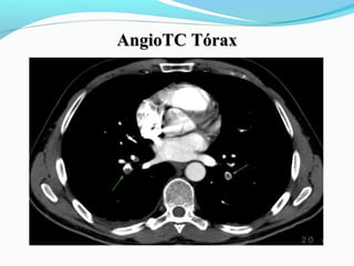 Angiotomografia | PPT