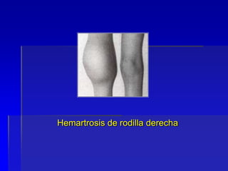 Clase 8 bsindrome hemorragico | PPT