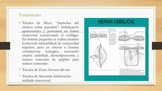 HERNIA UMBILICAL con o sin signos de complicacion.pdf