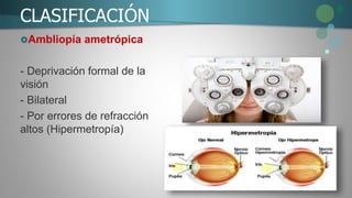 Clase De Ambliopia Pptx