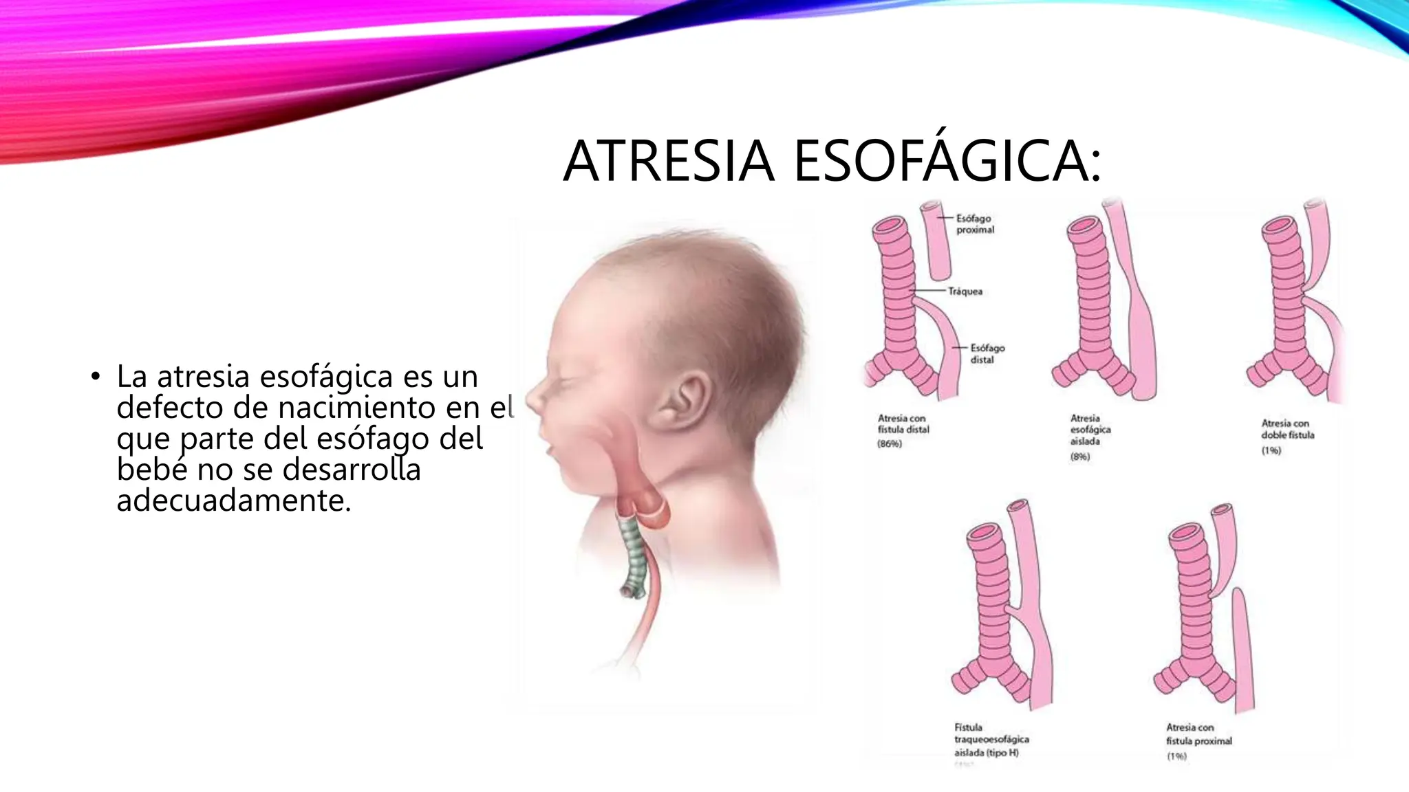 Atresia esofágica duodenal e intestinal | PPTX