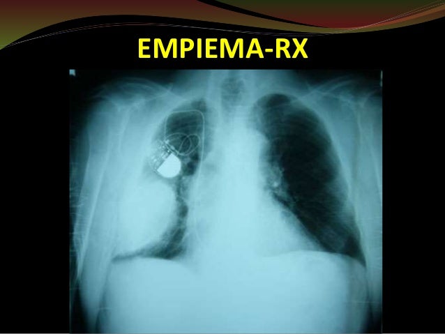 Clase de derrame pleural