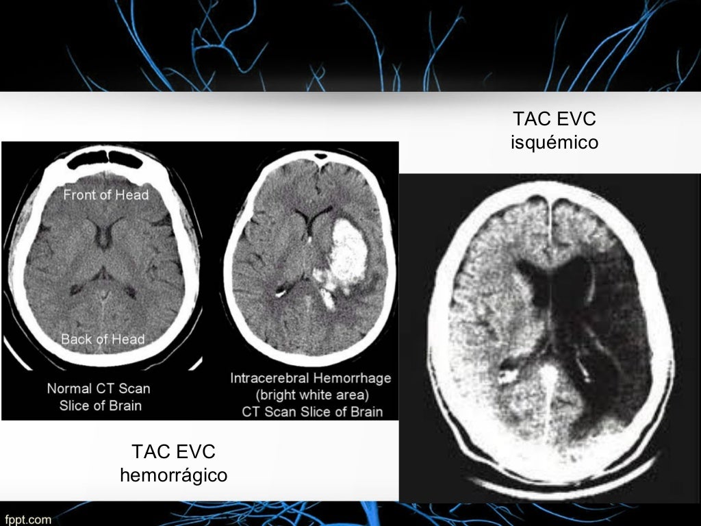 Enfermedad Vascular Cerebral Enfermedad Vascular Cerebral