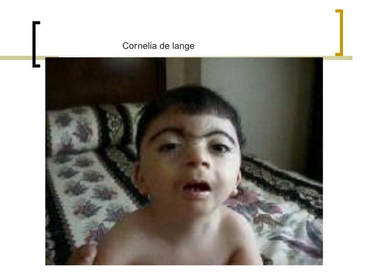 Синдром Корнелии Де Ланге Фото — Картинки фотографии