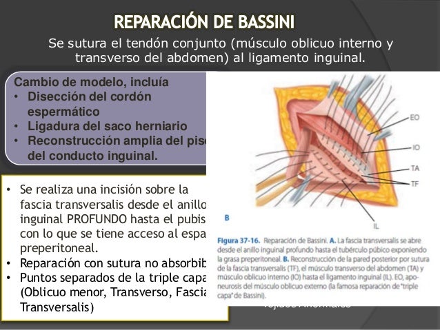 Clase de Hernia inguinal